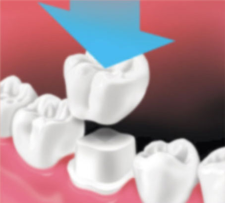 Crowns | Miles Dental