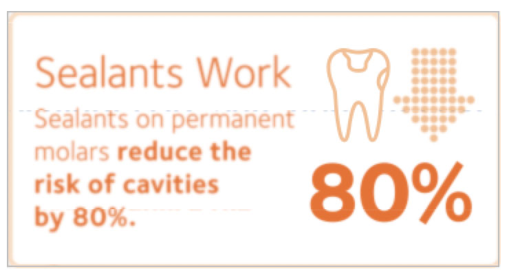 Sealant | Miles Dental