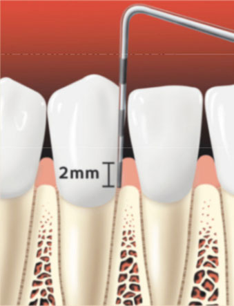 Periodontal Disease | Miles Dental